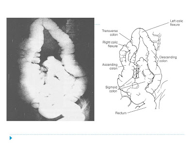 dunia xray: Teknik Radiografi Large Instestine/Usus Besar (Colon In Loop)