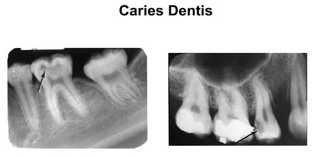 Radiologi: TEKNIK RADIOGRAFI DENTAL