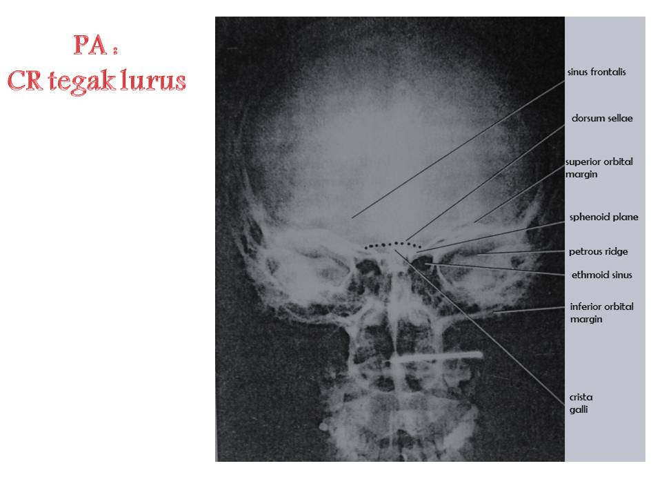 Teknik Radiografi Skull | Friends with Radiation | Dahrhiina Tjenno