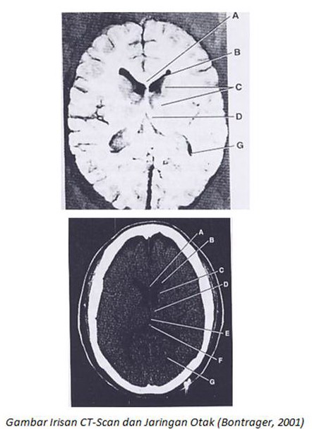 Teknik Pemeriksaan CT-Scan Kepala | ZONA RADIOLOGI