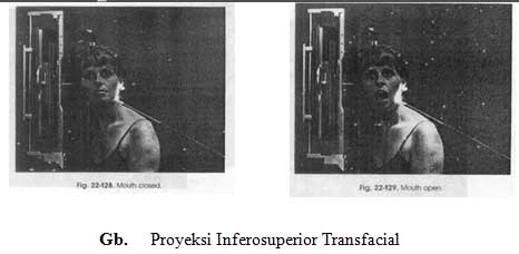 HIJAB'S RADIOLOGY: proyeksi temporal mandibula joint (TMJ)