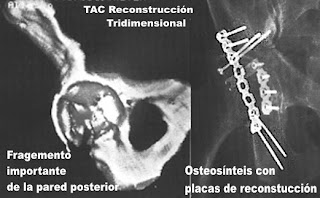 UNT PRACTICOS DE TRAUMATOLOGÍA: Lesiones traumaticas de Cadera y Pelvis
