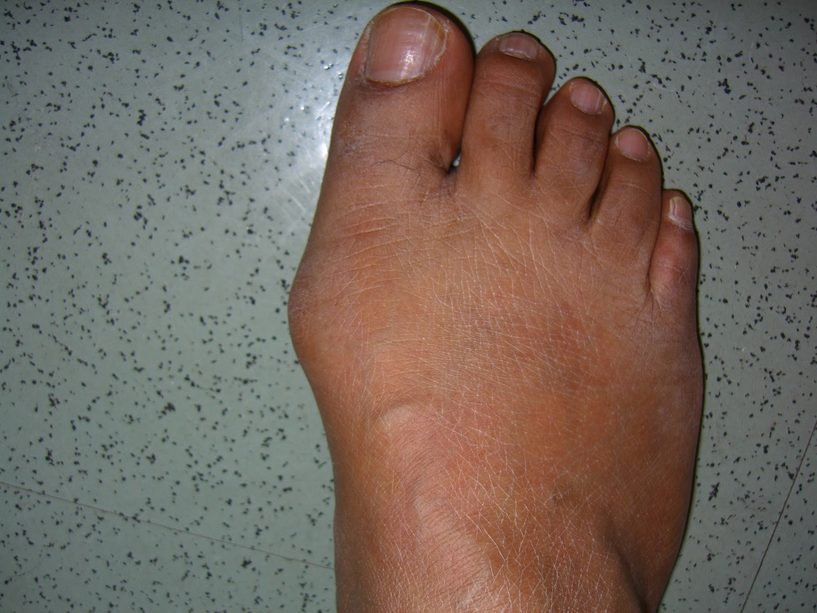 The Art of Bunion Surgery: Everyone's Guide for Great Results!: Do I ...