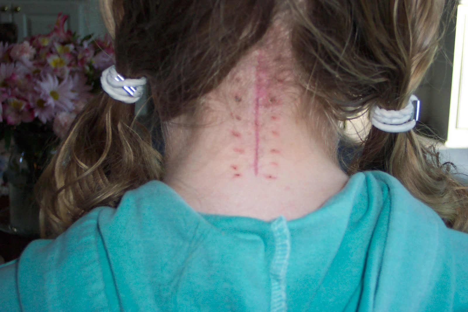 Chiari Malformation and My Daughter