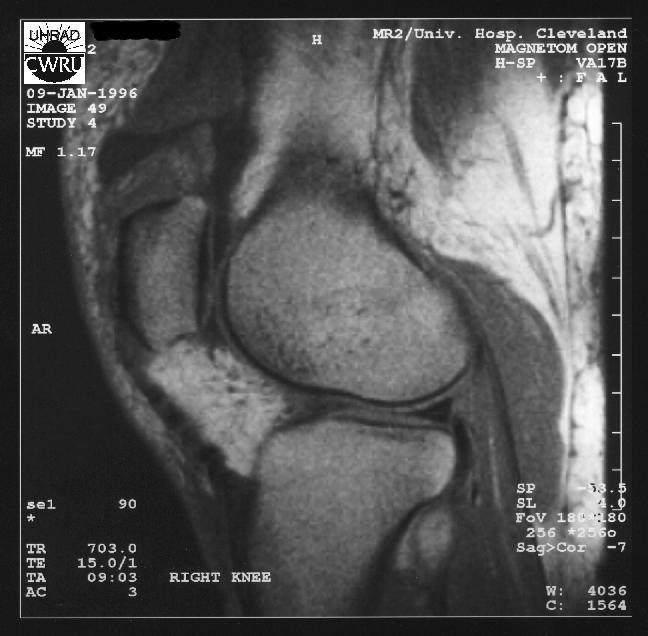 RadiologySpirit: Quadriceps Tendon Tear,