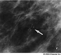 RadiologySpirit: BI-RADS AND CALCIFICATION(FIGURES 2)