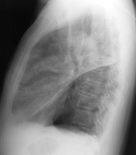 RadiologySpirit: Pneumonia=Acute Pulmonary Infiltrate