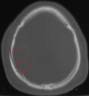 RadiologySpirit: Skull Fractures