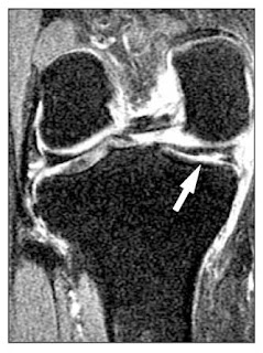 RadiologySpirit: Meniscal Tears