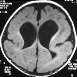 RadiologySpirit: Lissencephaly