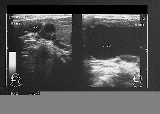 RadiologySpirit: Internal Jugular Vein Phlebectasia:
