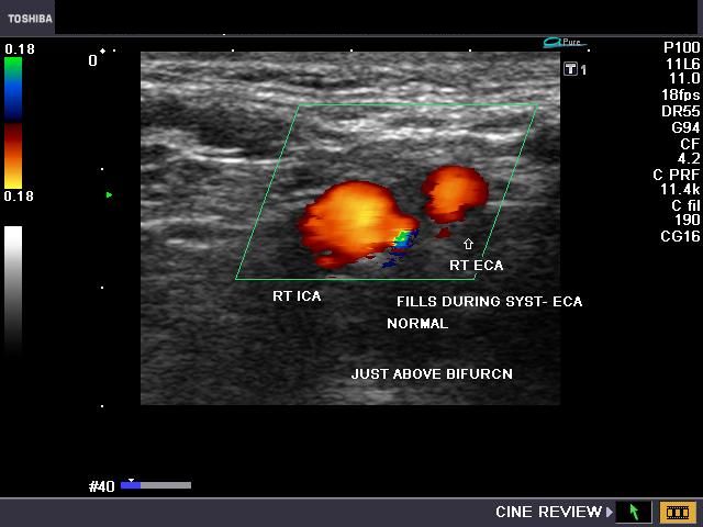 RadiologySpirit: Another sign to identify the ECA (external carotid ...