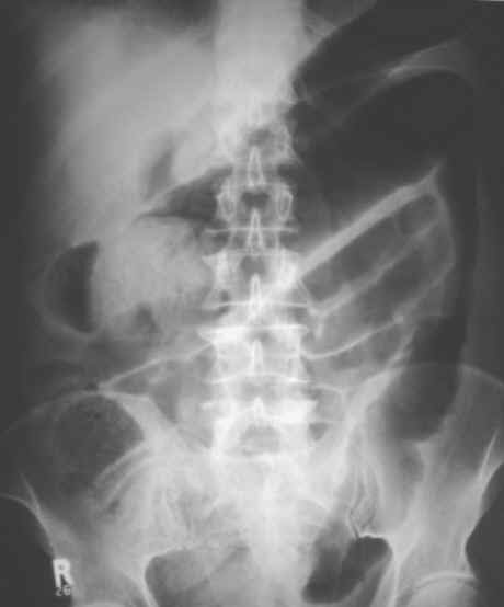 Toxic Megacolon Radiology