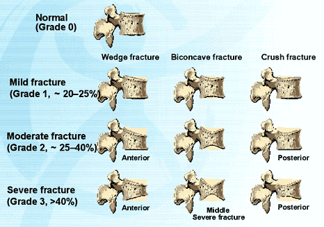 RadiologySpirit: grading of vertebral wedge fracture