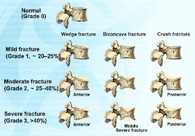 RadiologySpirit: grading of vertebral wedge fracture