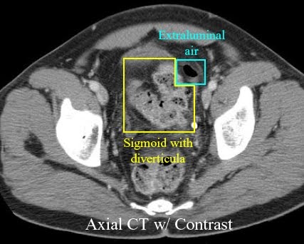 RadiologySpirit: Diverticulitis of the Sigmoid Colon with Extraluminal ...