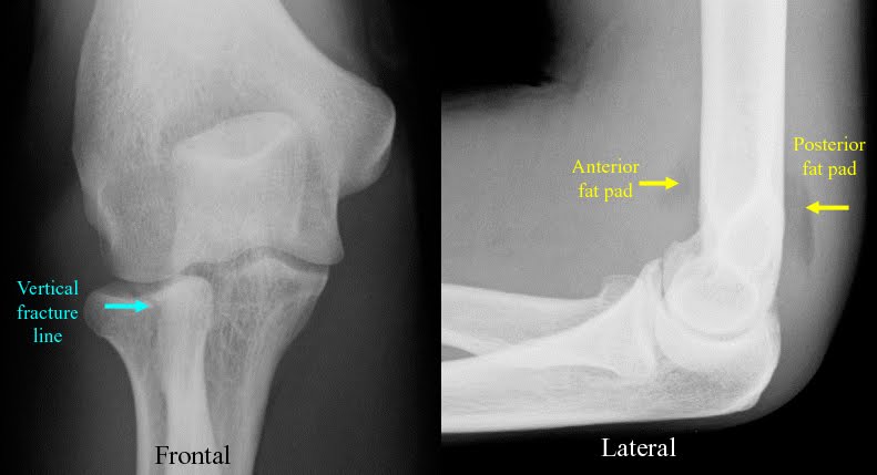 RadiologySpirit: Fracture of the Radial Head with Effusion on Plain Films