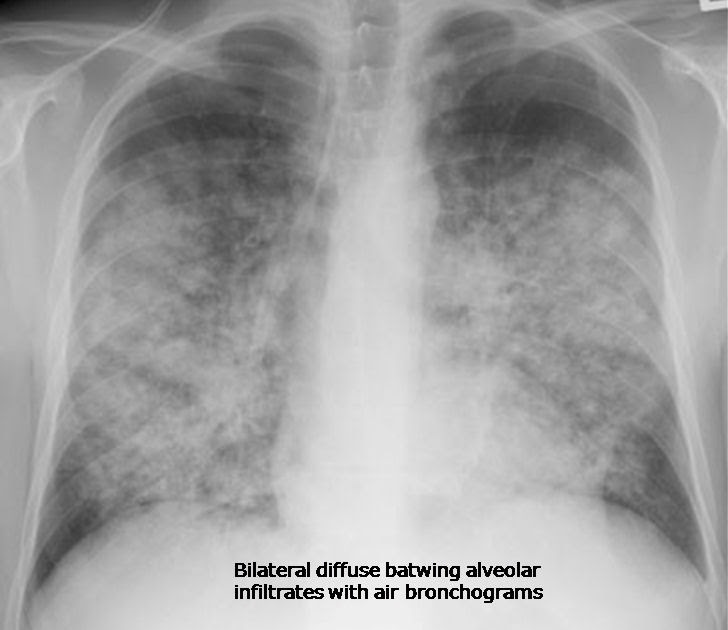 RadiologySpirit: CHF with alveolar edema