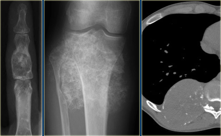RadiologySpirit: chondroid matrix