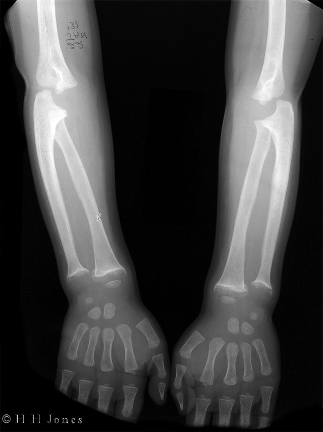 RadiologySpirit: mild rickets