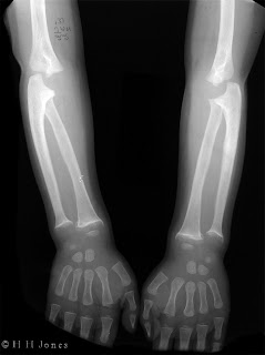 RadiologySpirit: mild rickets