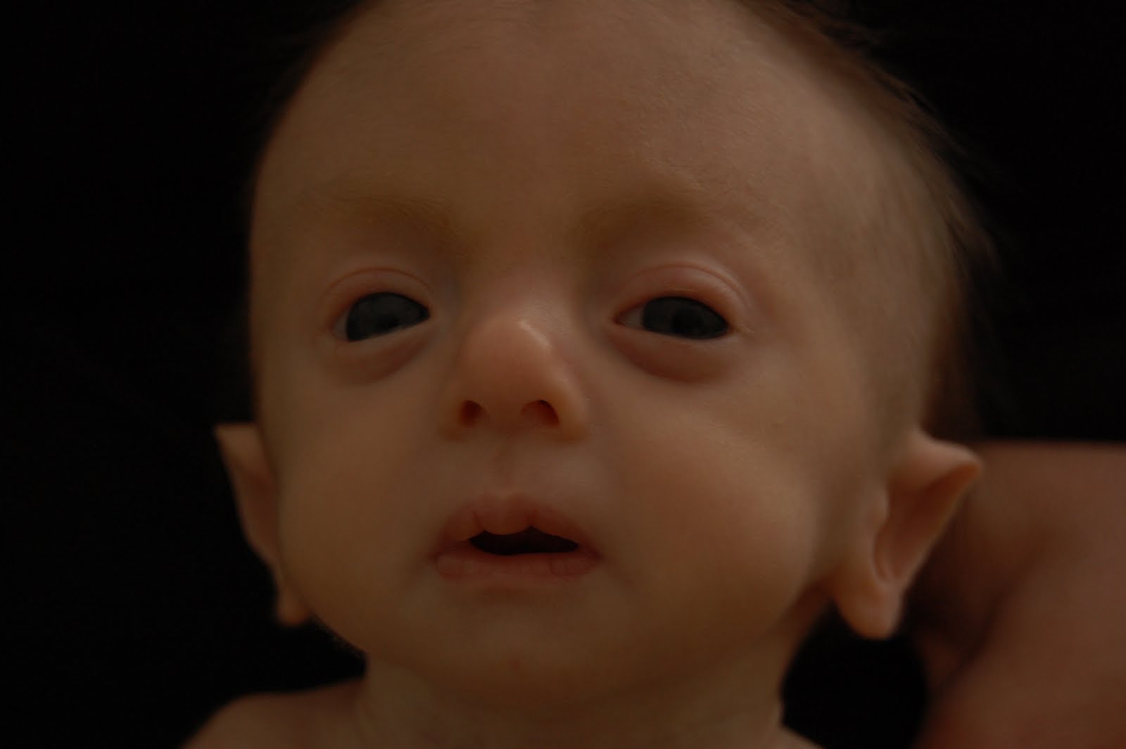 pray-for-lilly-lilly-s-trisomy-18-physical-features