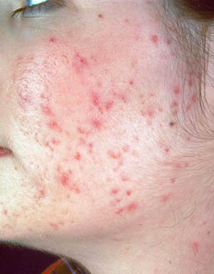 Acne - An Overview ~ Health Information