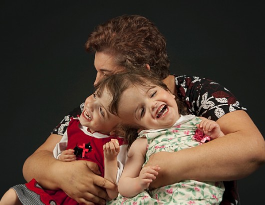 Free Amazing Images: Conjoined Twins Share a Brain