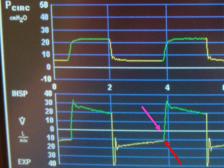 K. Scott Richey: Waveform of the week: Auto-PEEP