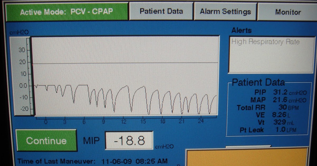 What Is The Normal Negative Inspiratory Force
