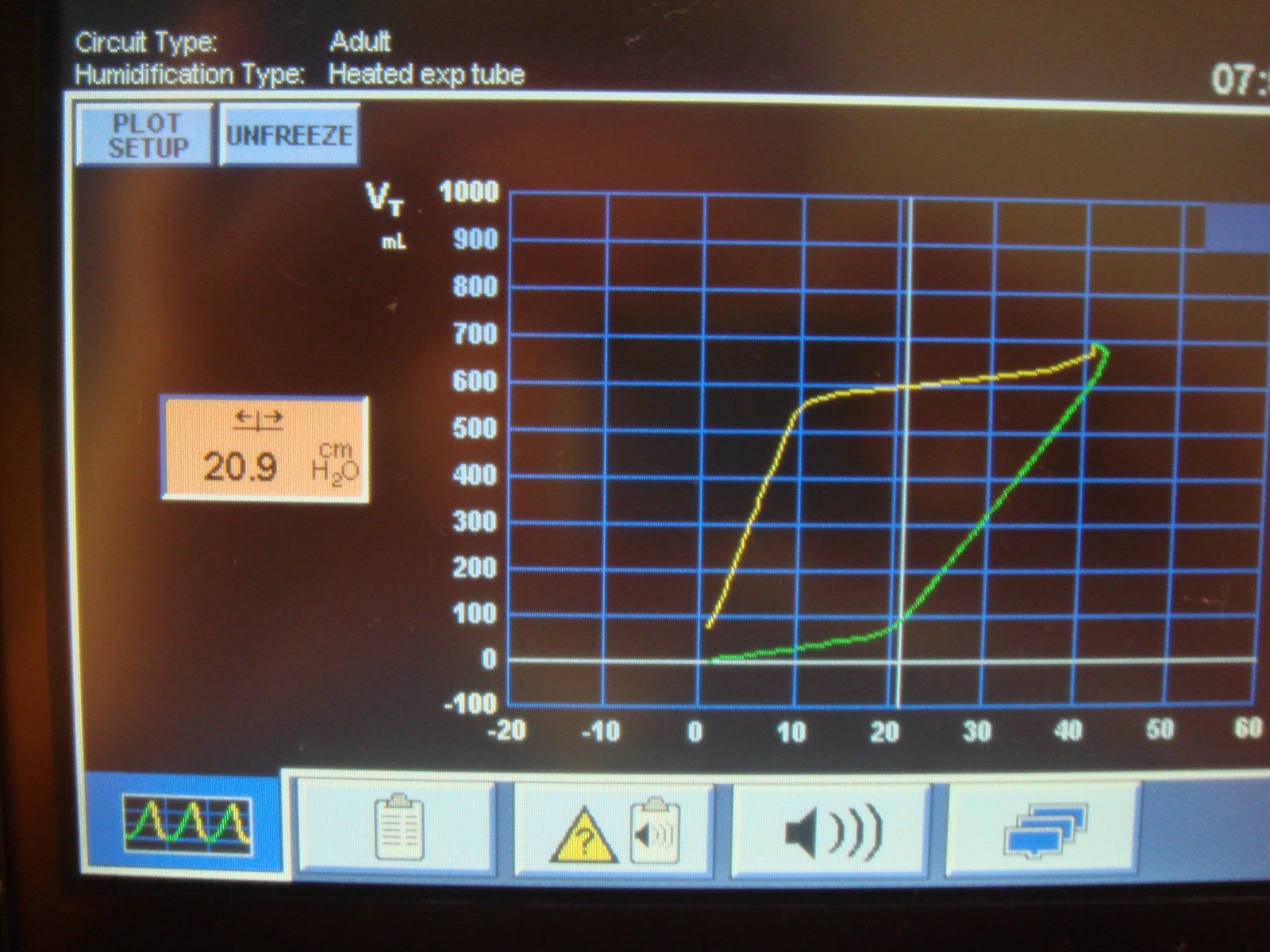 FREMITUS: Identifying Optimal PEEP with the PB 840 Ventilator: the ...