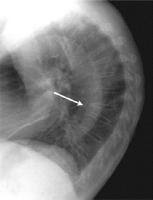 RADT413: Thoracic Spine Compression FX