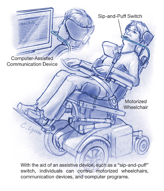 Fisio's Blog: AMYOTROPIC LATERAL SCLEROSIS ( ALS )