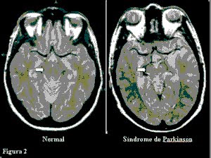Enfermedad de Parkinson: Concepto y clasificación de los síndromes ...