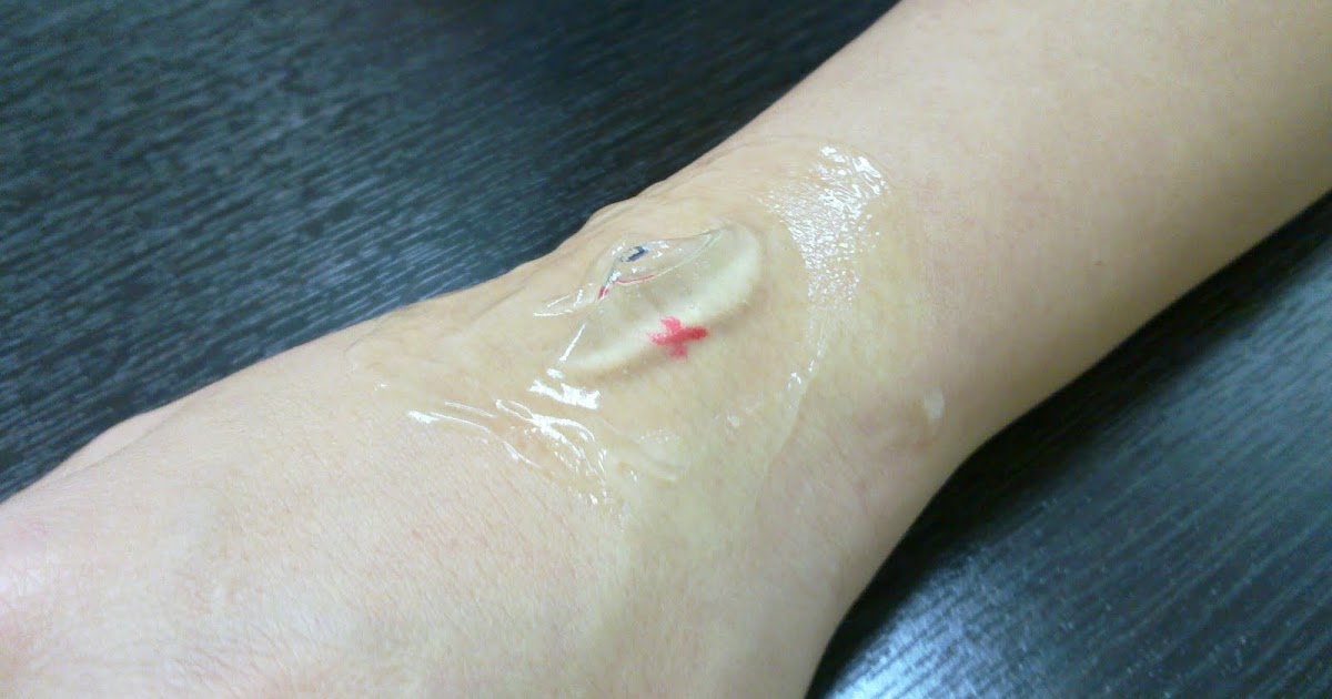 Sports and Medicine: Extensor Digitorum tenosynovitis