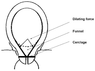 Cerclage Questions — The Bump