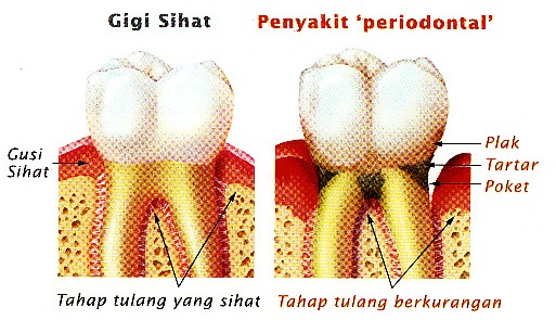 Dentist Online: Periodontal Disease : Menjaga Gusi yang Sihat