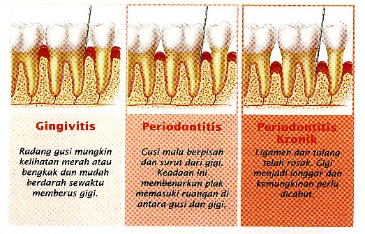 Dentist Online: Periodontal Disease : Menjaga Gusi yang Sihat