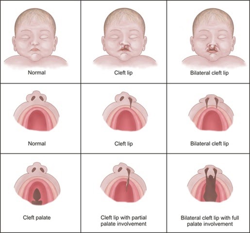 Cleft Palate: EMedicine