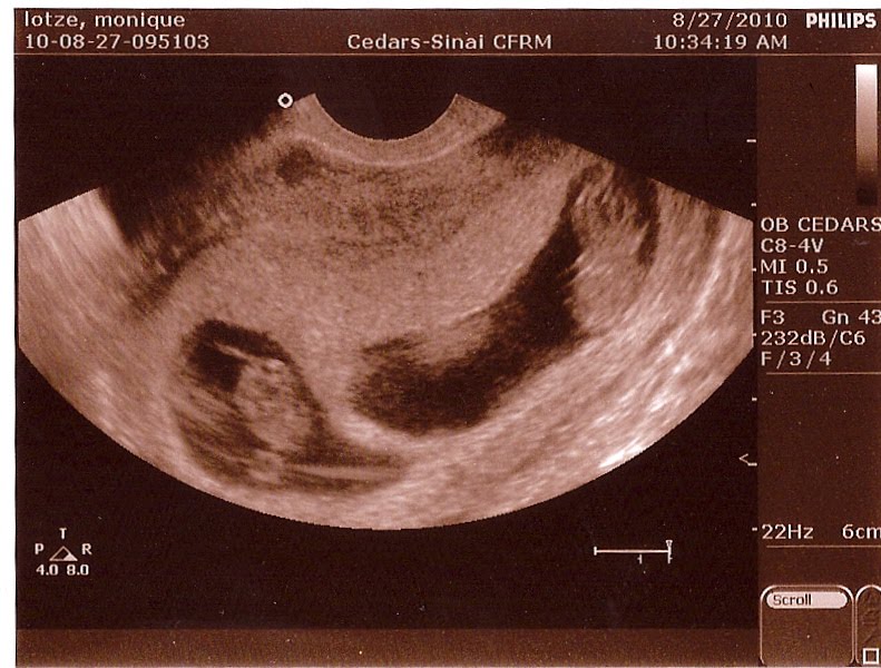 TheLotzeFamily: 8 Weeks, 6 days