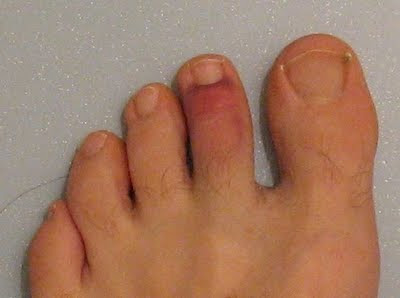 Pain at the Base of the Middle Toes- The Complete Treatment Guide!