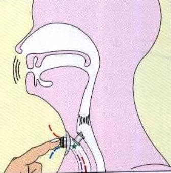 "Vivir con una Laringectomia" : Tres Métodos diferentes para recuperar ...