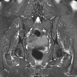 mri procedures and pathology: Trochanteric Bursitis