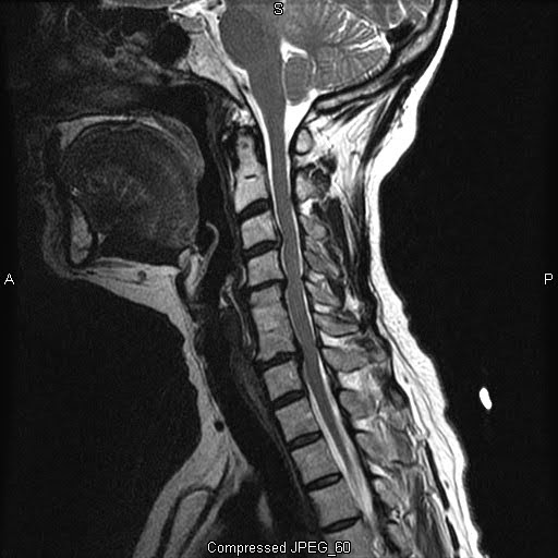 mri procedures and pathology: Cervical Stenosis