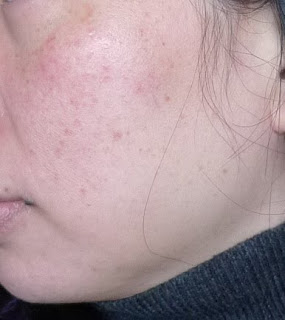 我的 Refoderm Tonic Water 體驗