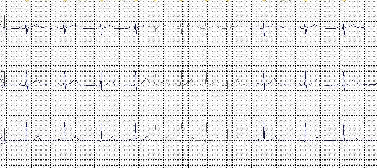 Atlas de Holter: TPSV