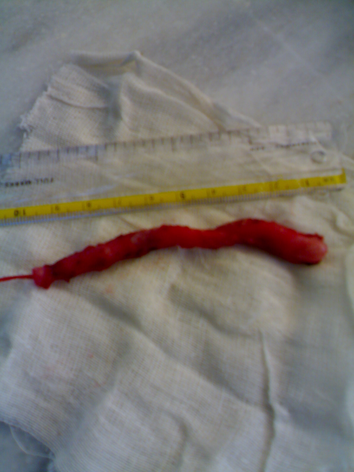 TechieDoc: Appendectomy specimen- 10 cm long appendix