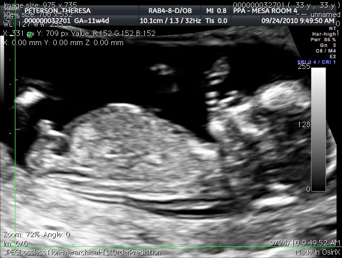 Ava and Grant: 11 week ultrasound photos