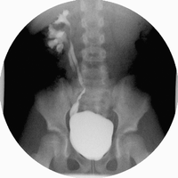 MARMARA ÜROLOJİ @Cevdetdr: VOİDİNG SİSTOÜRETROGRAFİ (VCUG) NEDİR?