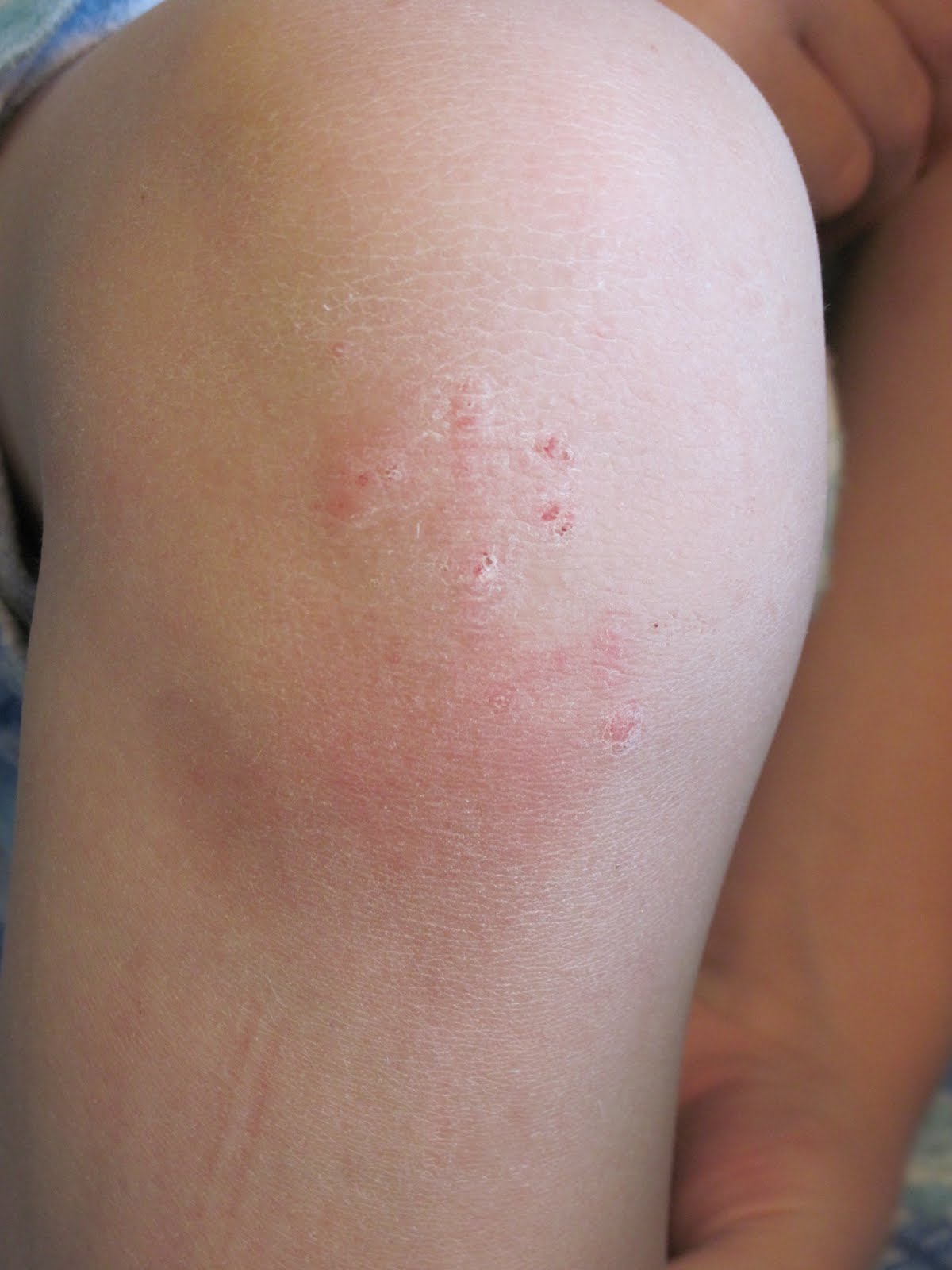 Common Warts On Knee